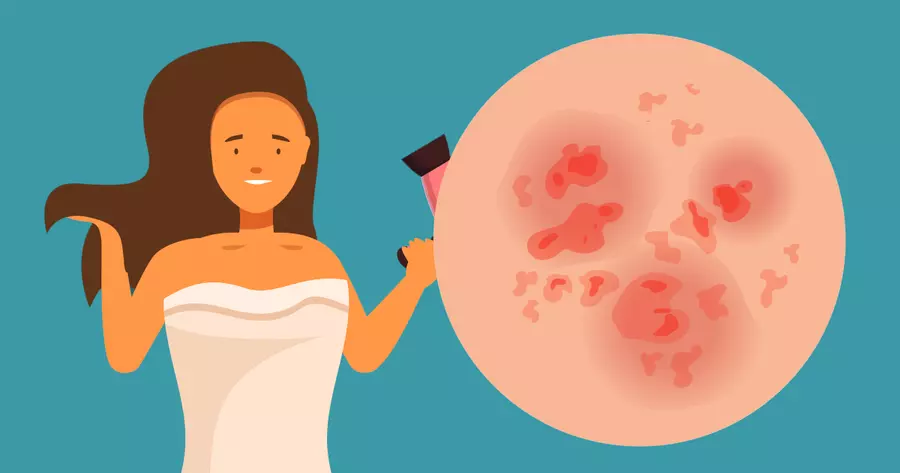 Mottled Skin After a Shower With Lupus: Should You Be Concerned ...