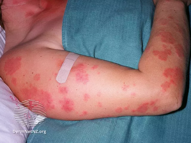 Lupus Rash on Buttocks: 7 Things To Know | MyLupusTeam