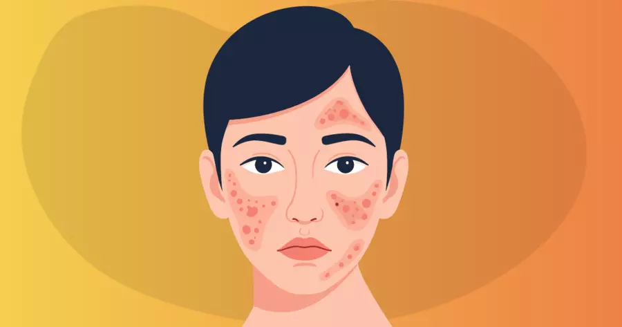 Does Lupus Rash Feel Hot? Inflammation, Temperature, and Other Factors ...