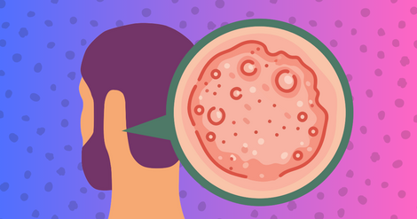 Why Hidradenitis Suppurativa Smells Bad During a Flare | myHSteam
