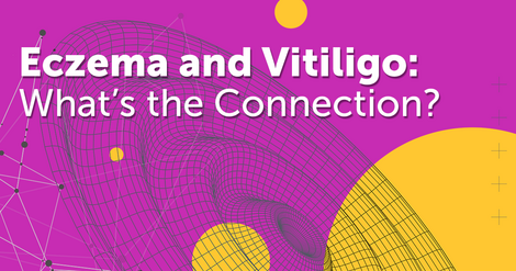Tinea Versicolor vs. Vitiligo: What’s the Difference? | MyVitiligoTeam