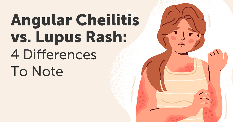 Lupus Information | MyLupusTeam