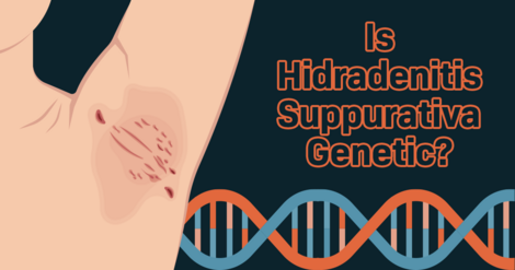 Are HS Triggers Preventable? 7 Potential Triggers and More | myHSteam