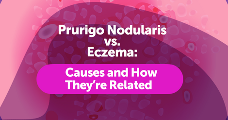 Prurigo Nodularis: An Overview | MyPrurigoTeam