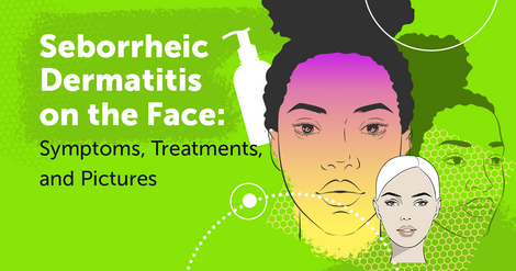 Can Seborrheic Dermatitis Cause Acne? | MySebDermTeam