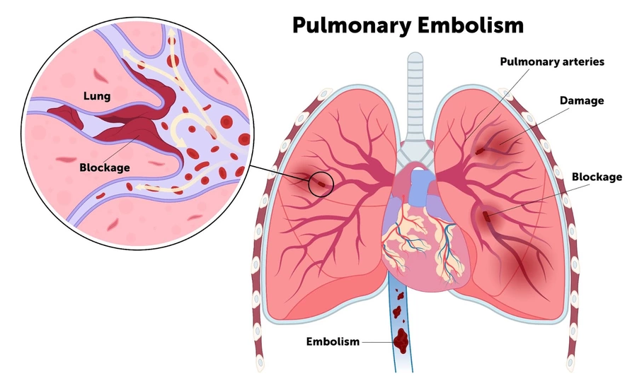 Pleural Effusion Pneumothorax Hemothorax And Atelectasis 58 OFF Pleural Effusion Pneumothorax Hemothorax And Atelectasis 58 OFF