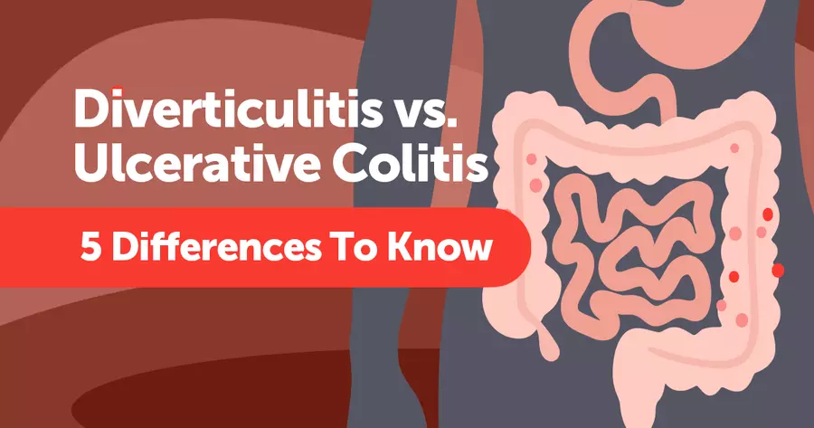 Diverticulitis vs. Ulcerative Colitis: 5 Differences To Know | MyCrohnsAndColitisTeam