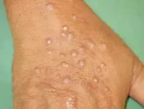 Asthma With Itchy Skin Rash: 5 Skin Conditions To Know | MyAsthmaTeam