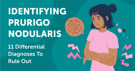 What Does Prurigo Nodularis Look Like? Pictures for Reference ...