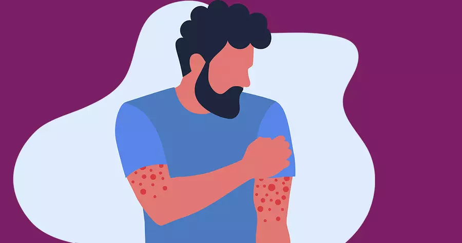 Skin Rashes With Ulcerative Colitis: What Do They Look Like? Pictures ...