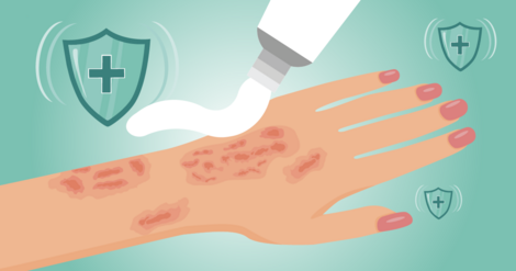 Can Psoriasis Cause Swollen Lymph Nodes? | MyPsoriasisTeam