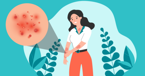Psoriasis in the Belly Button: Symptoms and Treatment | MyPsoriasisTeam