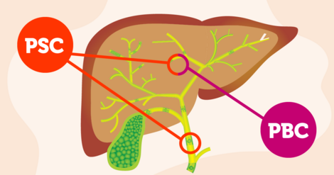 Living With PBC: 8 Tips for Managing Symptoms | myPBCteam