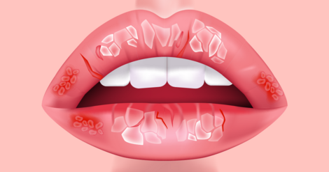 5 Ways To Manage Itching and Burning With Seborrheic Dermatitis ...