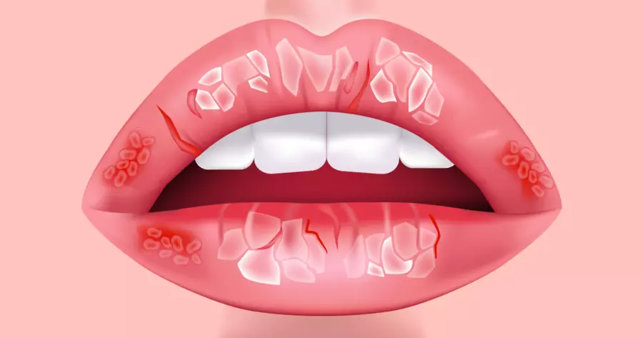 Seborrheic Dermatitis on the Lips: Treatment, Symptoms, and More ...