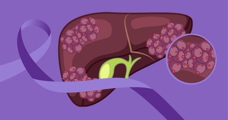 PBC Stages and Symptoms: Understanding the Progression | myPBCteam