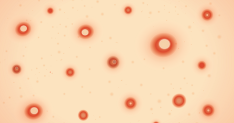 Hidradenitis Suppurativa (HS) Stages | myHSteam