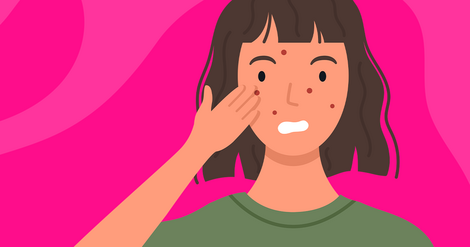 5 Ways To Manage Itching and Burning With Seborrheic Dermatitis ...