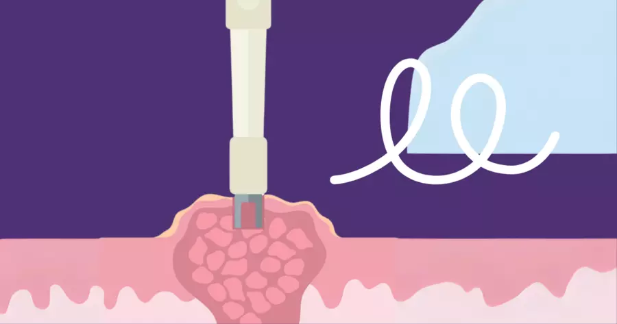 Biopsy for Melanoma: 5 Types and What To Expect for Each | MyMelanomaTeam