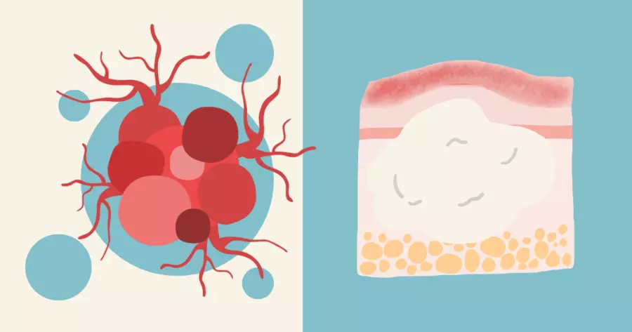 Desmoid Tumor vs Dermoid Cyst: 6 Differences and 4 Similarities ...