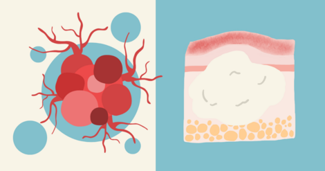 What Are Desmoid Tumors? 5 Facts To Know | MyDesmoidTumorTeam