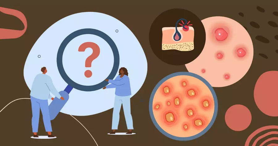 What Can Be Misdiagnosed as HS? Boils, Acne, Folliculitis, and More ...