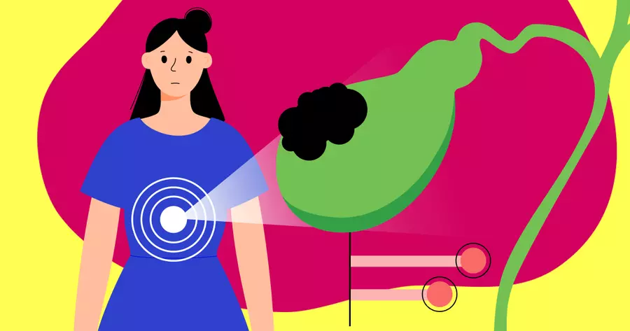 Stage 3 Bladder Cancer: Survival Rate, Symptoms, and More ...