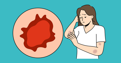 Recurring Skin Abscesses: What Causes Them To Return? | myHSteam