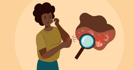 Difference Between a Hidradenitis Suppurativa vs Pilonidal Cyst | myHSteam