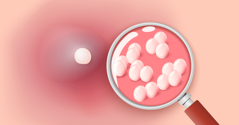 Boils and Abscesses: What Is the Difference Between a Boil and an ...