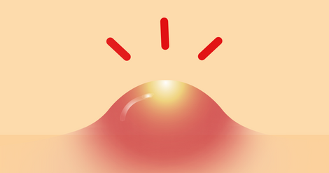 Pus-Filled Bump on Vagina: 7 Possible Causes and Treatment Tips | myHSteam