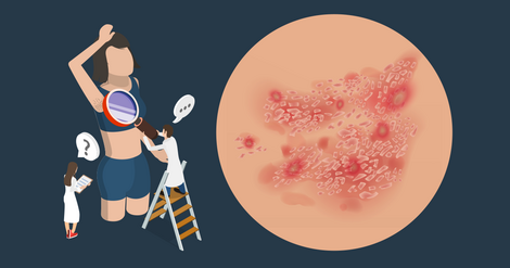 Facial Hidradenitis Suppurativa: Treating and Managing HS on the Face ...