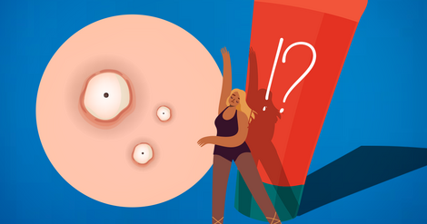 5 Over-the-Counter Treatments for Hidradenitis Suppurativa To Try ...