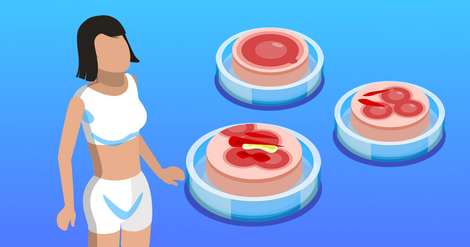 Hidradenitis Suppurativa Stages: What Are the 3 Hurley Stages? | myHSteam