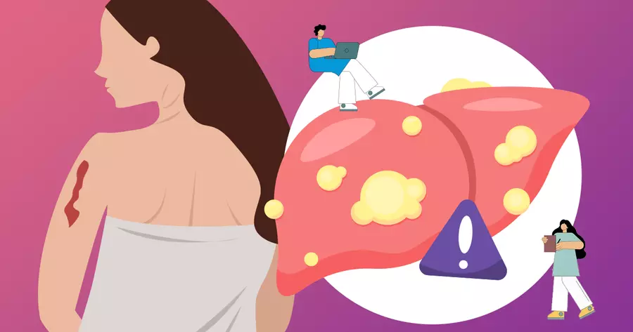 Thin Skin and Easy Bruising: Are They Symptoms of PBC? | myPBCteam