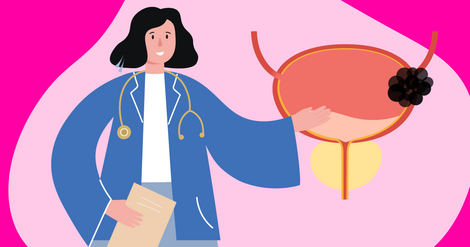 High-Risk Non-Muscle-Invasive Bladder Cancer: 5 Facts | MyBladderCancerTeam