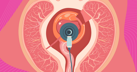 BCG Treatment for Bladder Cancer: Long-Term Side Effects, Success Rate ...