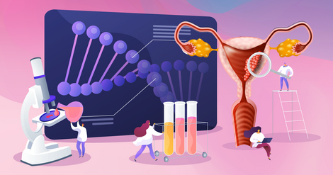 4 Stages of Endometrial Cancer: Survival Rates and More ...