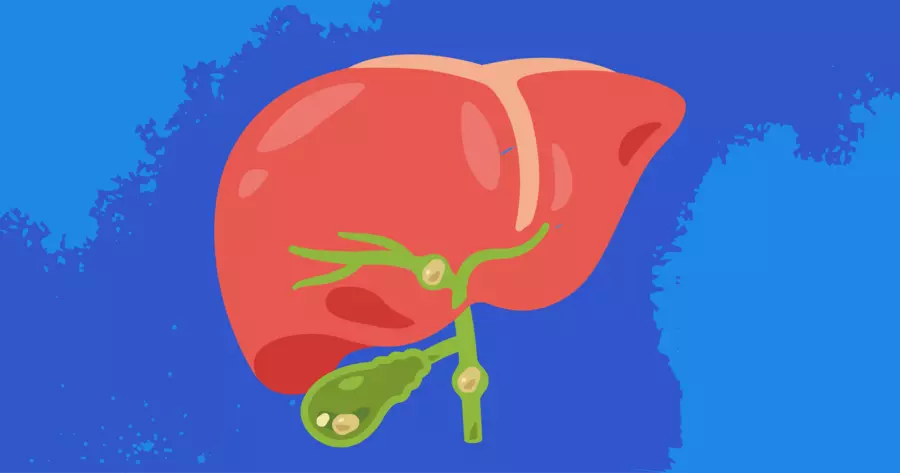 Primary Biliary Cholangitis vs. Cholecystitis: How Are They Different ...