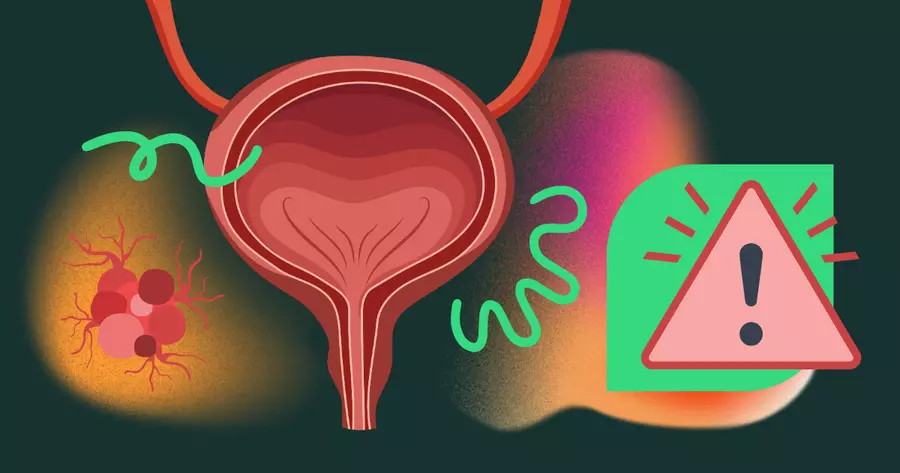 High-Risk Non-Muscle-Invasive Bladder Cancer: 5 Facts | MyBladderCancerTeam