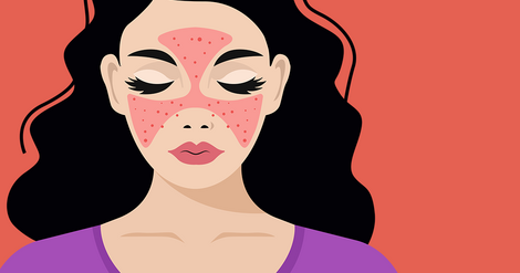 Early Signs of Lupus in Women: Symptoms To Watch For | MyLupusTeam