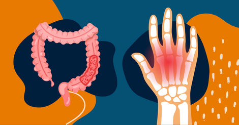 Ulcerative Colitis vs. IBS: What’s the Difference? | MyCrohnsAndColitisTeam