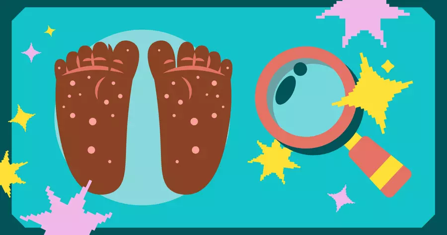 Itchy Pus-Filled Bumps on Feet: What Are These Painful Sores? | myHSteam