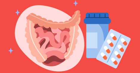 3 Types of Infusion Treatments for Ulcerative Colitis ...
