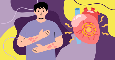 Shingles Chest Pain vs. Heart Attack Pain: How They Compare ...