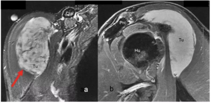 What Desmoid Tumors Look Like: A Visual Guide | MyDesmoidTumorTeam